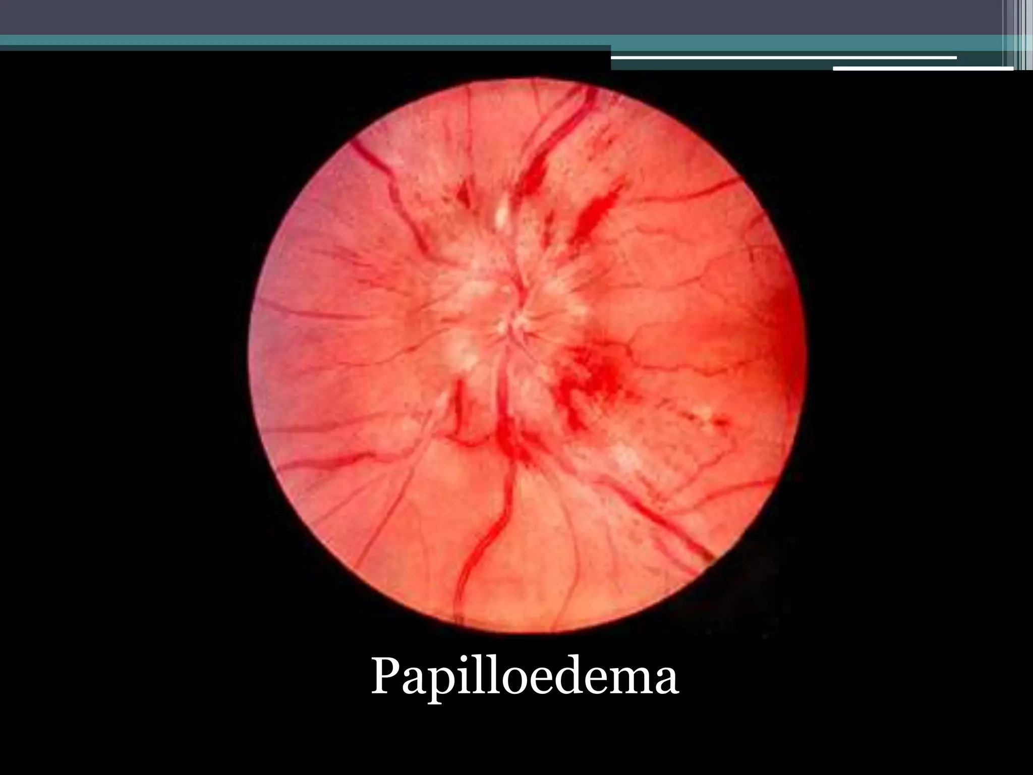 Direct Ophthalmoscopy/Fundoscopy | PPTX