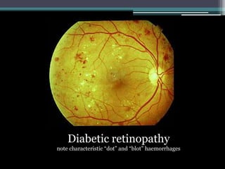 Direct Ophthalmoscopy/Fundoscopy | PPT