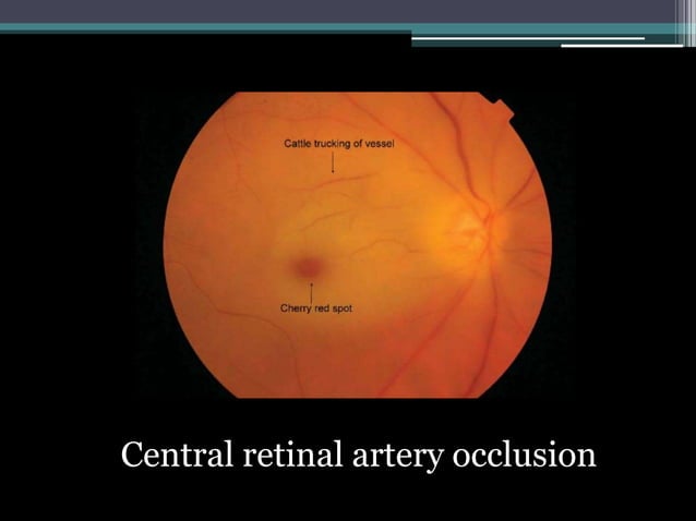 Direct Ophthalmoscopy/Fundoscopy | PPT