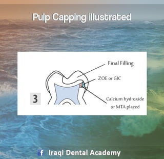 Direct Pulp Capping - An Overview | PDF