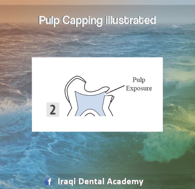 Direct Pulp Capping - An Overview | PDF