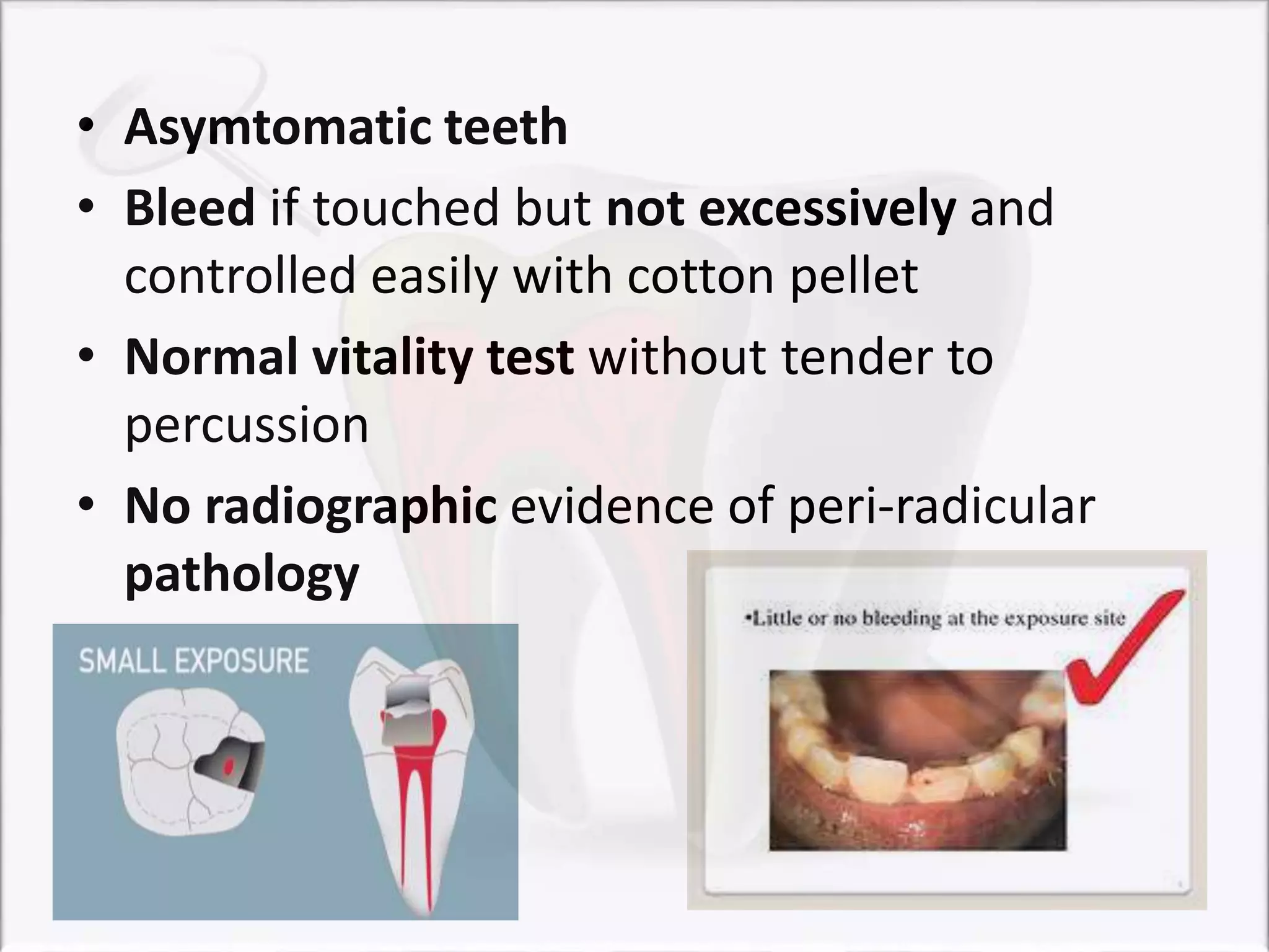 Direct pulp capping | PPTX
