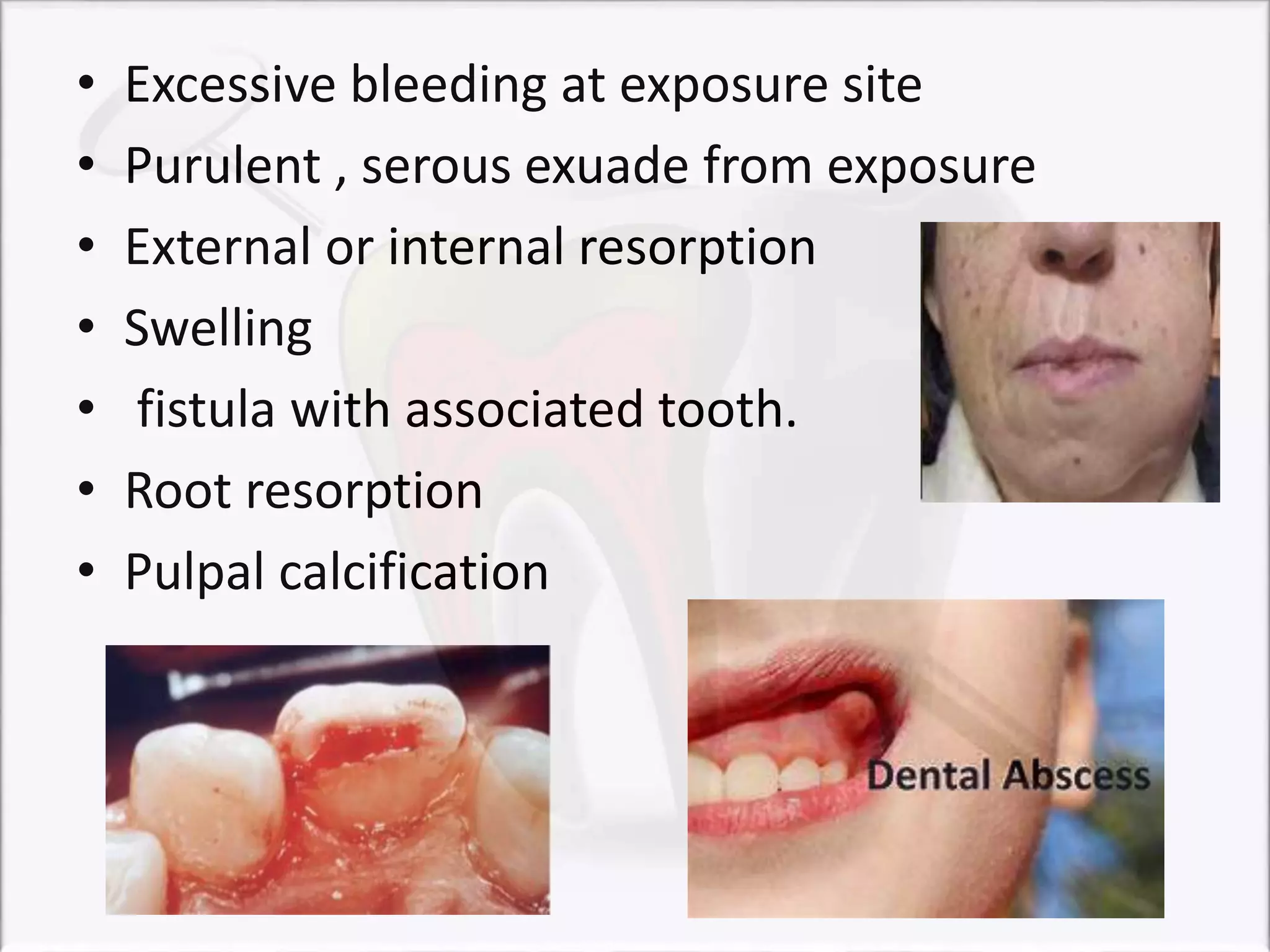 Direct pulp capping | PPTX