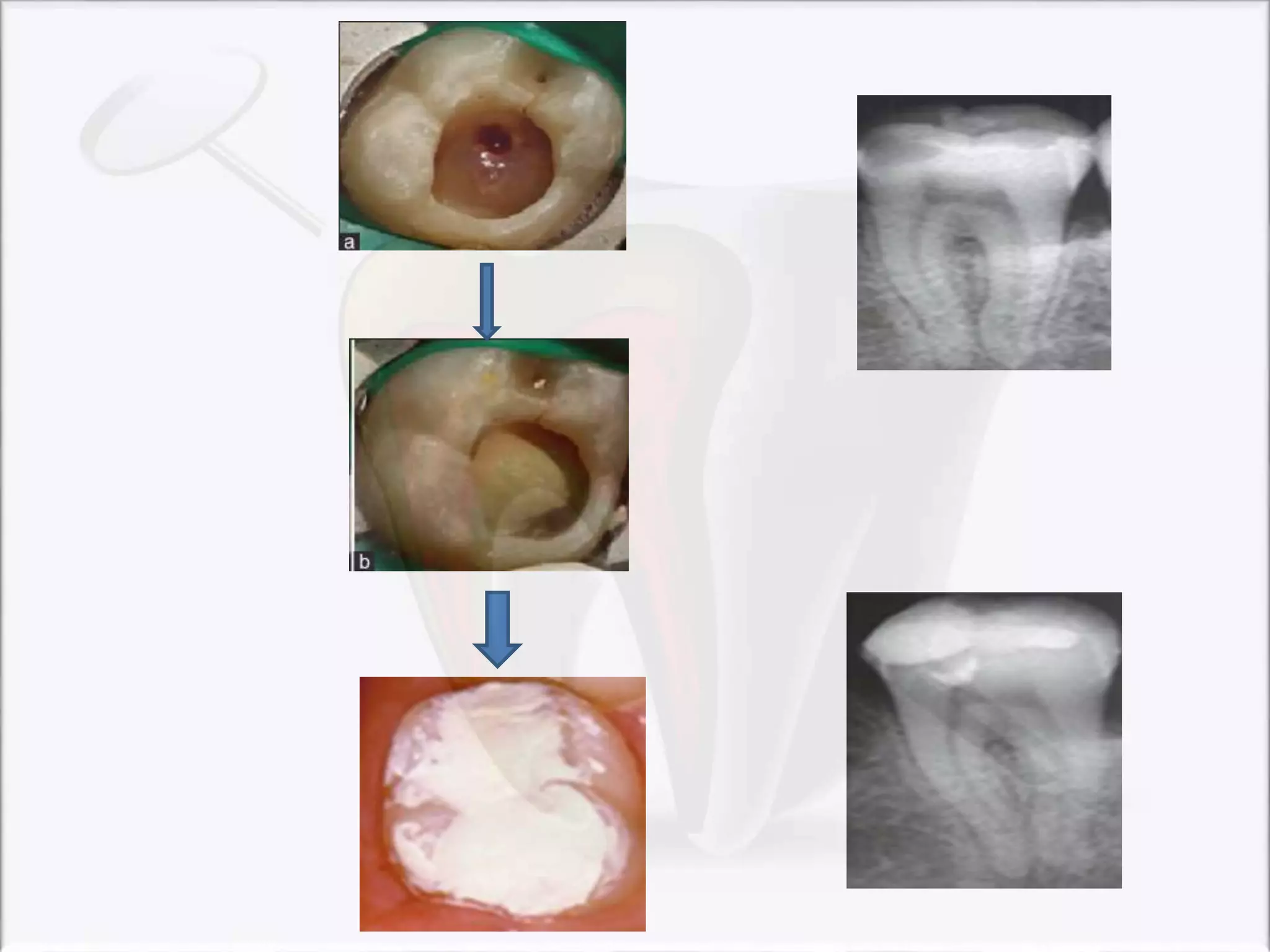 Direct pulp capping | PPTX