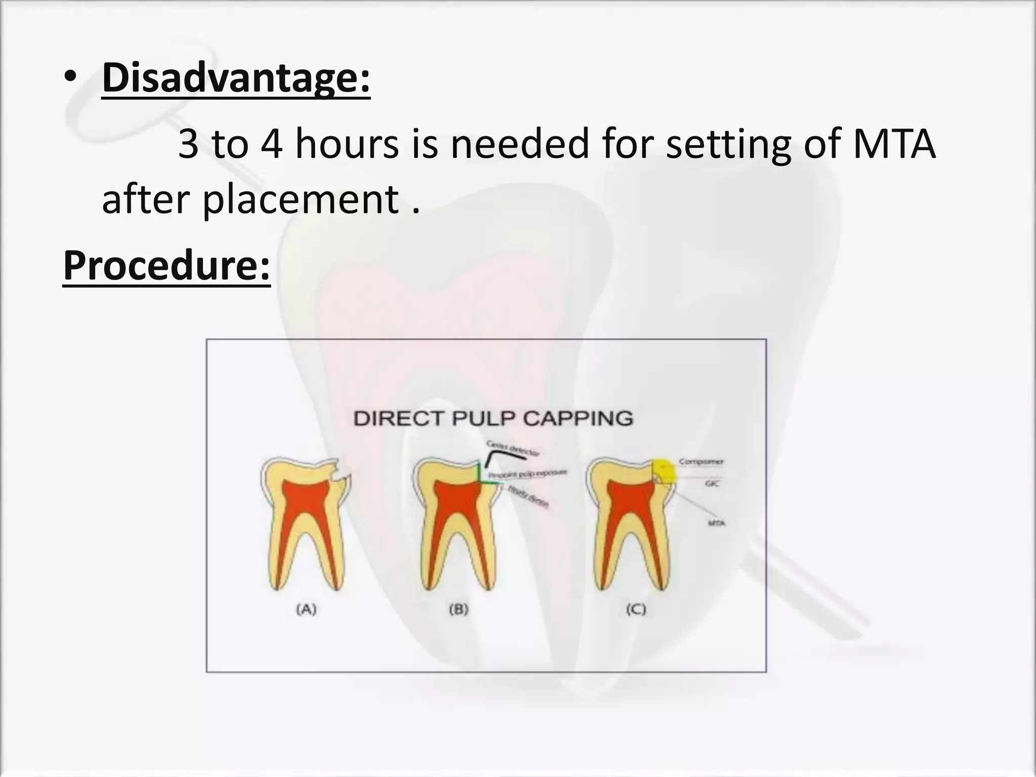 Direct pulp capping | PPTX