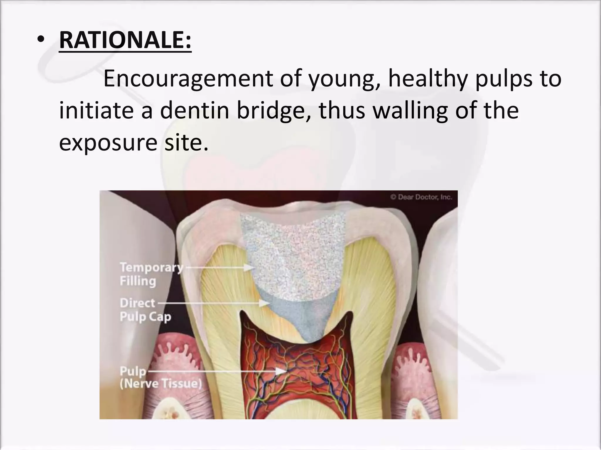 Direct pulp capping | PPTX