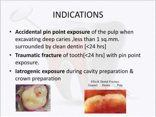 Direct pulp capping | PPTX