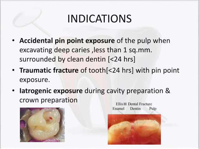 Direct pulp capping | PPTX | Dental Health | Diseases and Conditions
