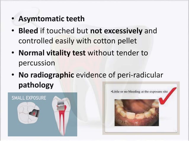 Direct pulp capping | PPTX | Dental Health | Diseases and Conditions