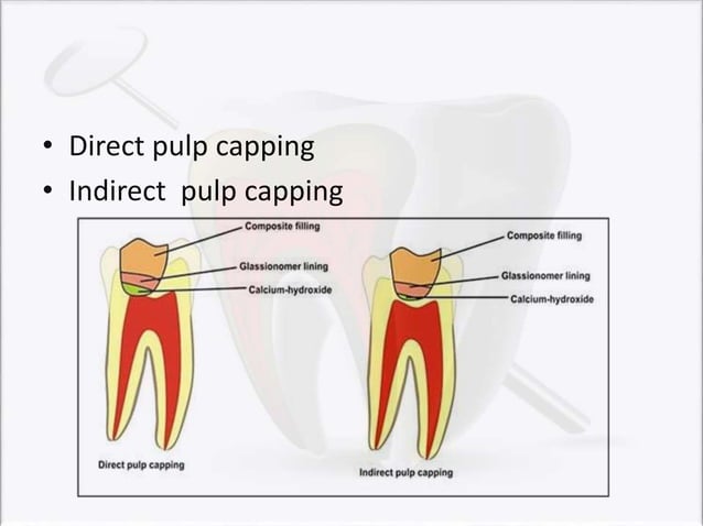 Direct pulp capping | PPTX | Dental Health | Diseases and Conditions