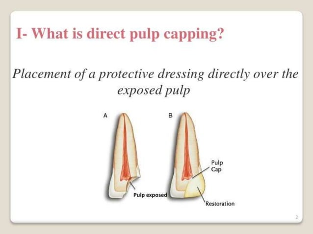 Direct pulp capping | PPT