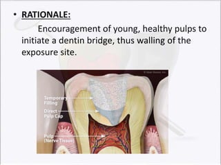 Direct pulp capping | PPTX