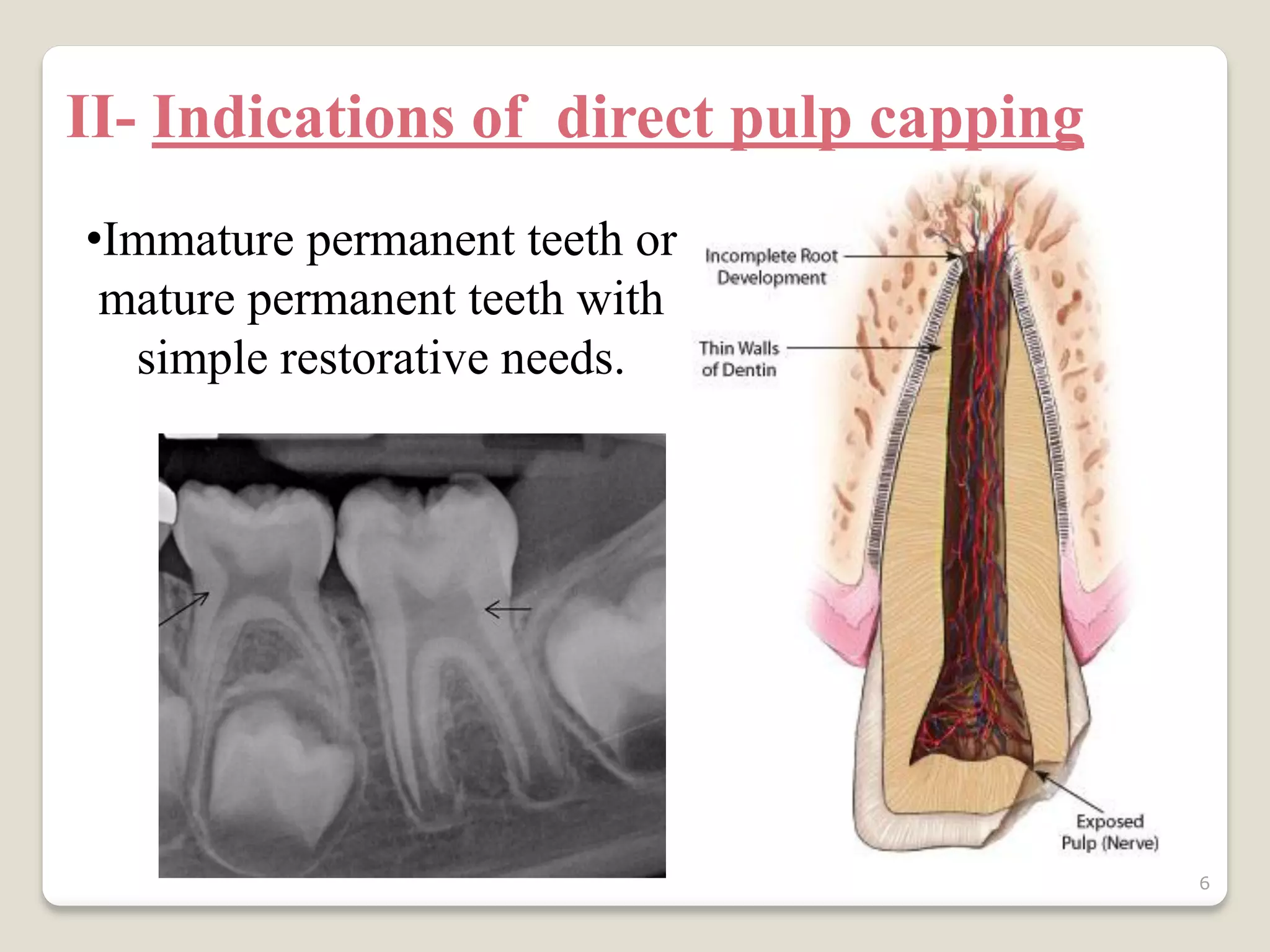Direct pulp capping | PDF