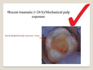 Direct pulp capping | PDF