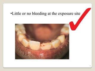 Direct pulp capping | PDF