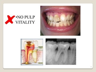 Direct pulp capping | PDF