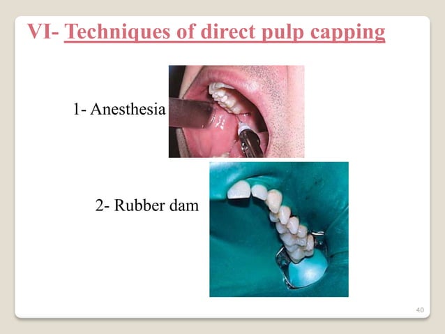 Direct pulp capping