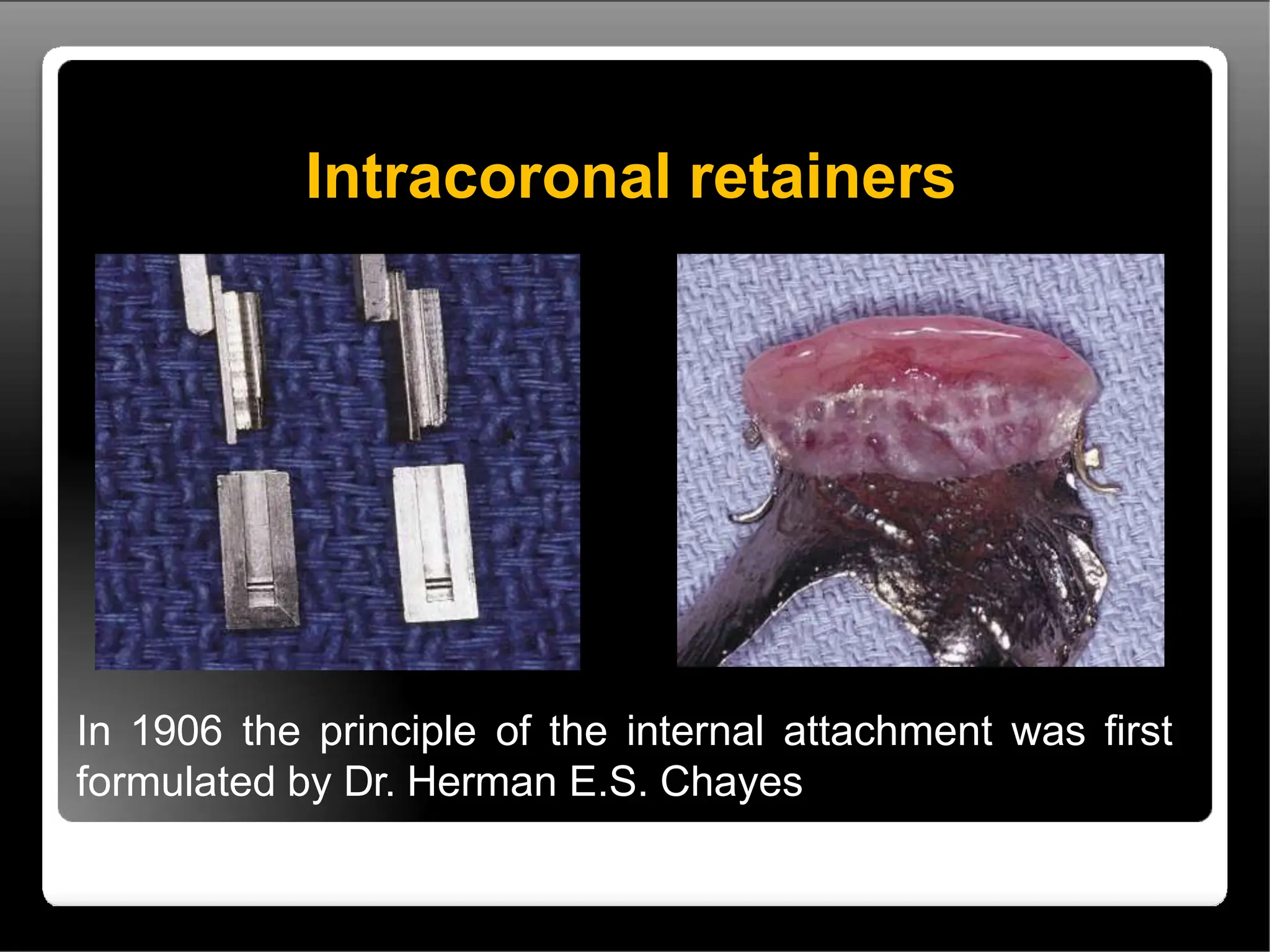direct retainer in Cast partial Dentures.pptx