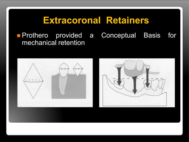 direct retainer in Cast partial Dentures.pptx