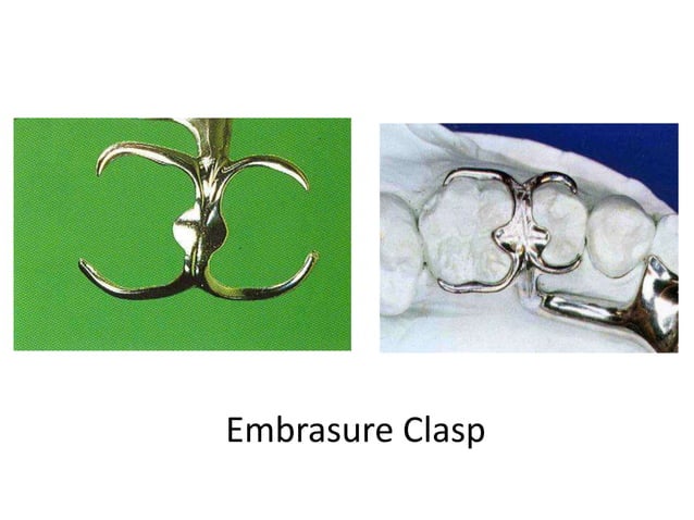 Direct retainers.pptx | Dental Health | Diseases and Conditions