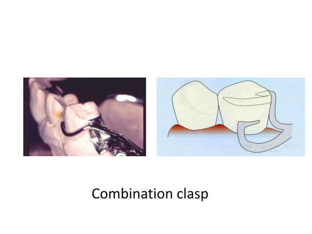 Direct retainers.pptx | Dental Health | Diseases and Conditions