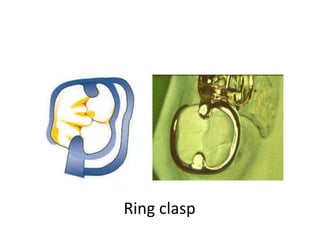 Direct retainers.pptx | Dental Health | Diseases and Conditions