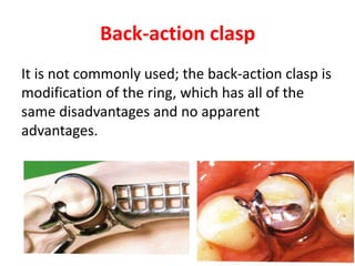 Direct retainers.pptx | Dental Health | Diseases and Conditions