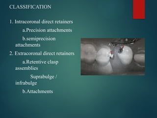 DIRECT RETAINERS in removablepartialdenture.pptx