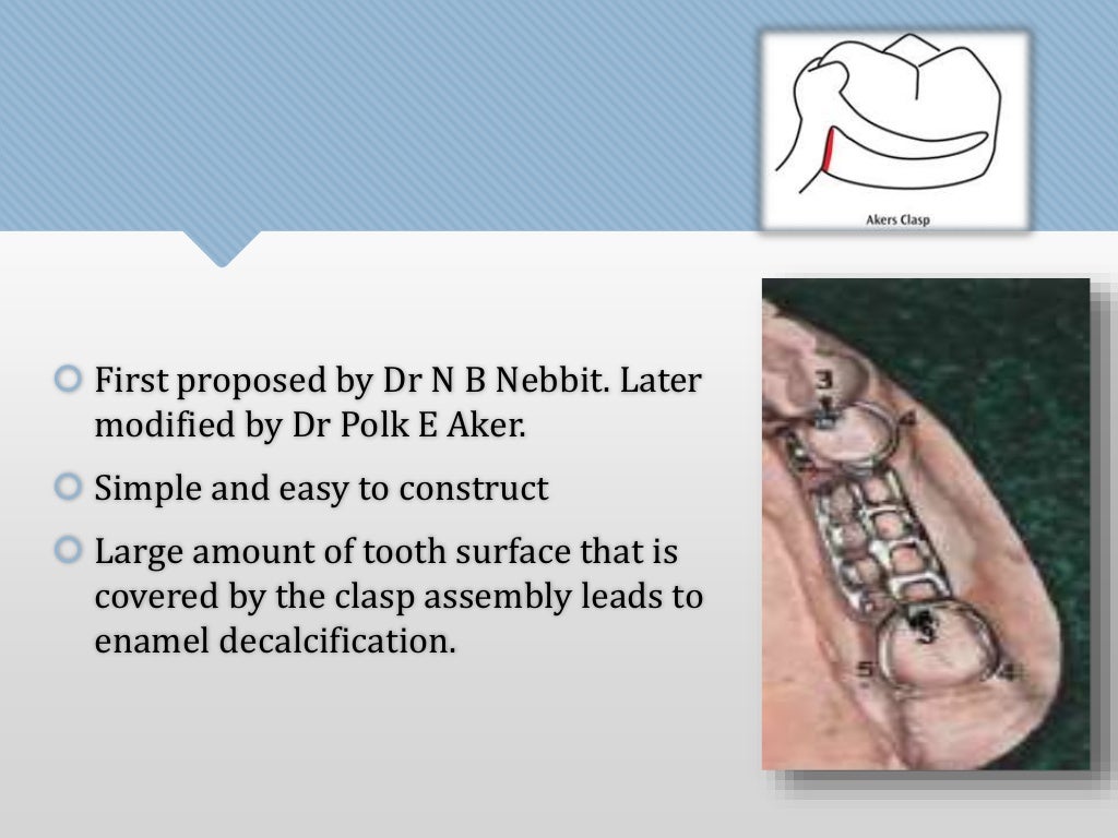 Direct retainers in removable partial dentures