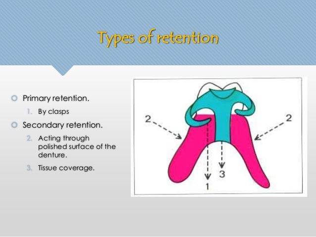Direct retainers in removable partial dentures