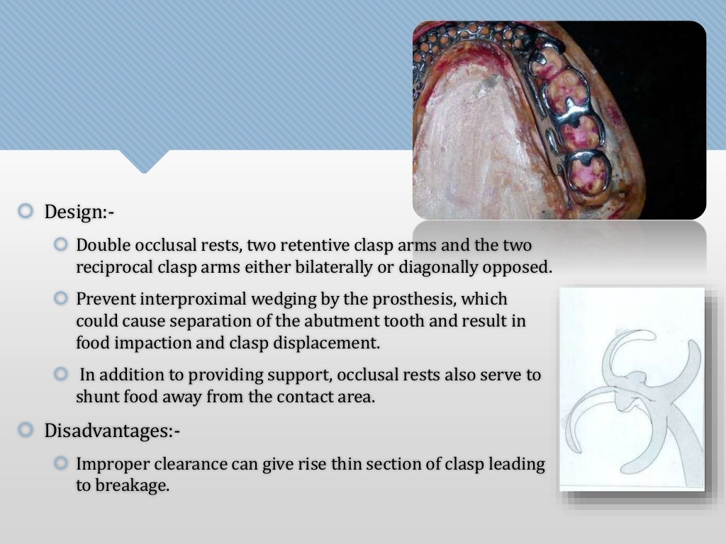 Direct retainers in removable partial dentures