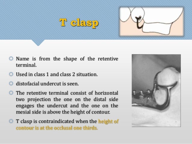 Direct retainers in removable partial dentures