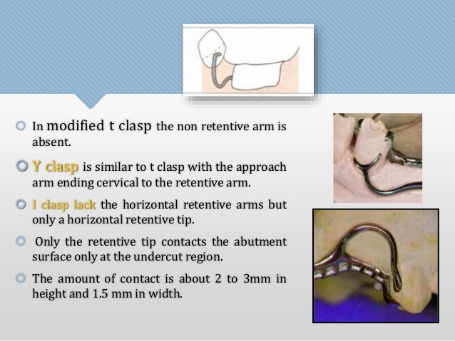 Direct retainers in removable partial dentures