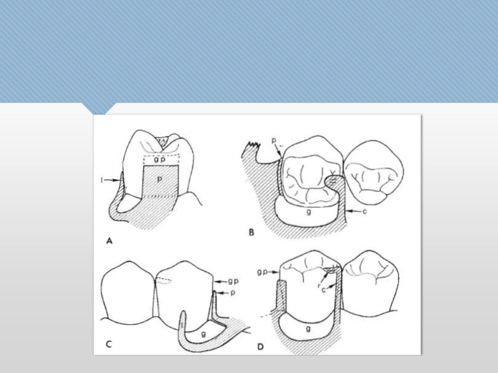 Direct retainers in removable partial dentures