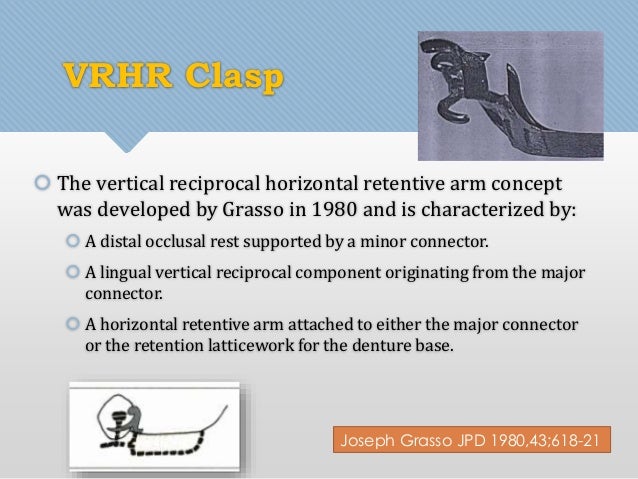 Direct retainers in removable partial dentures
