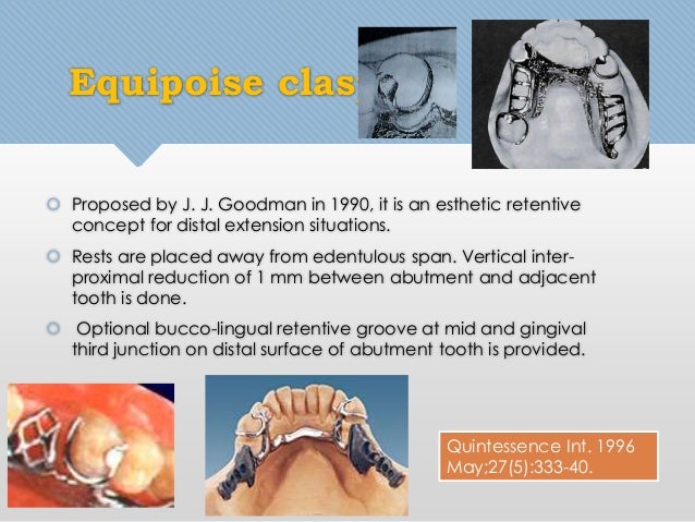 Direct retainers in removable partial dentures