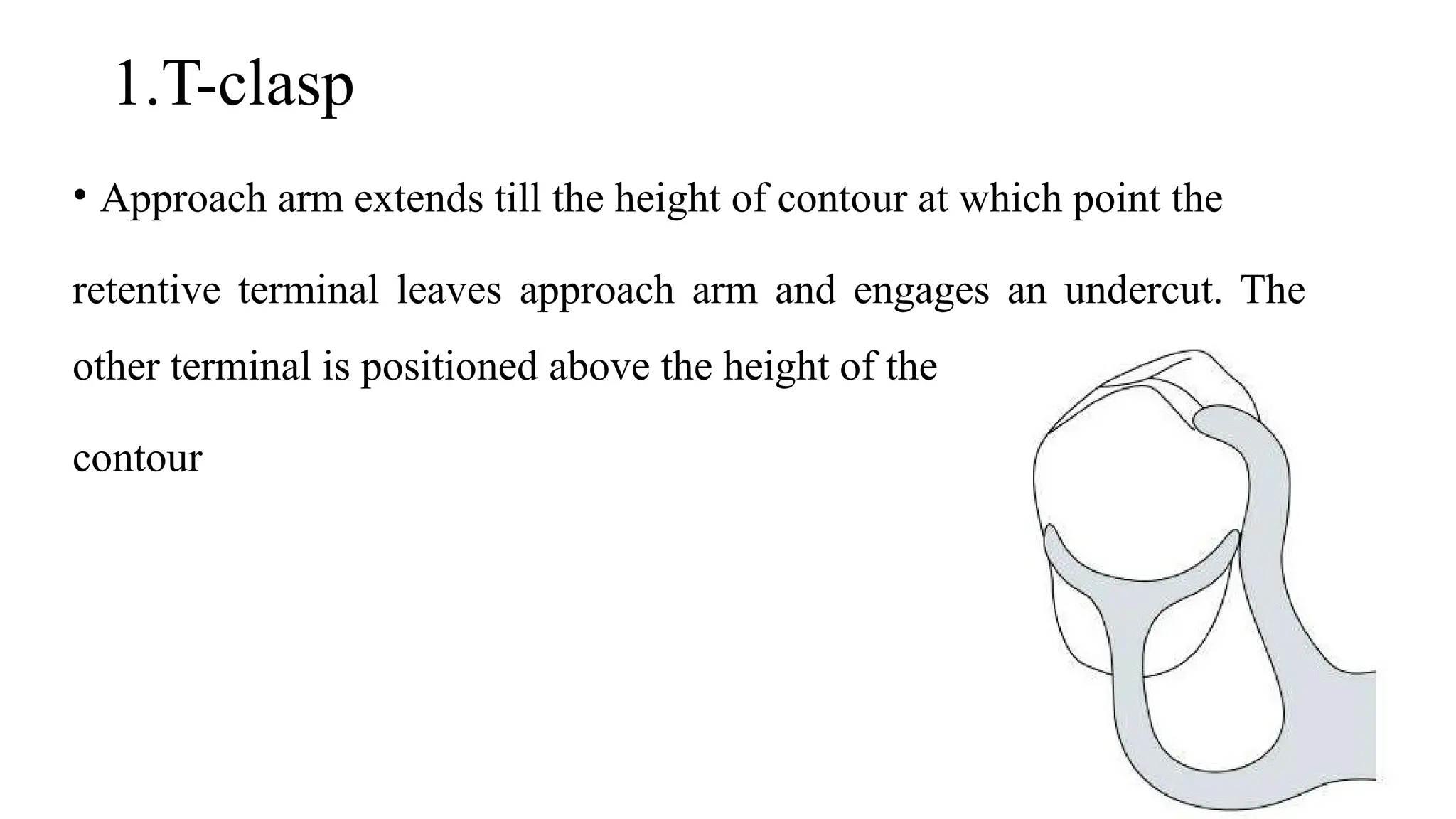 DIRECT RETAINERS IN REMOVABLE PARTIAL DENTURE | PPTX