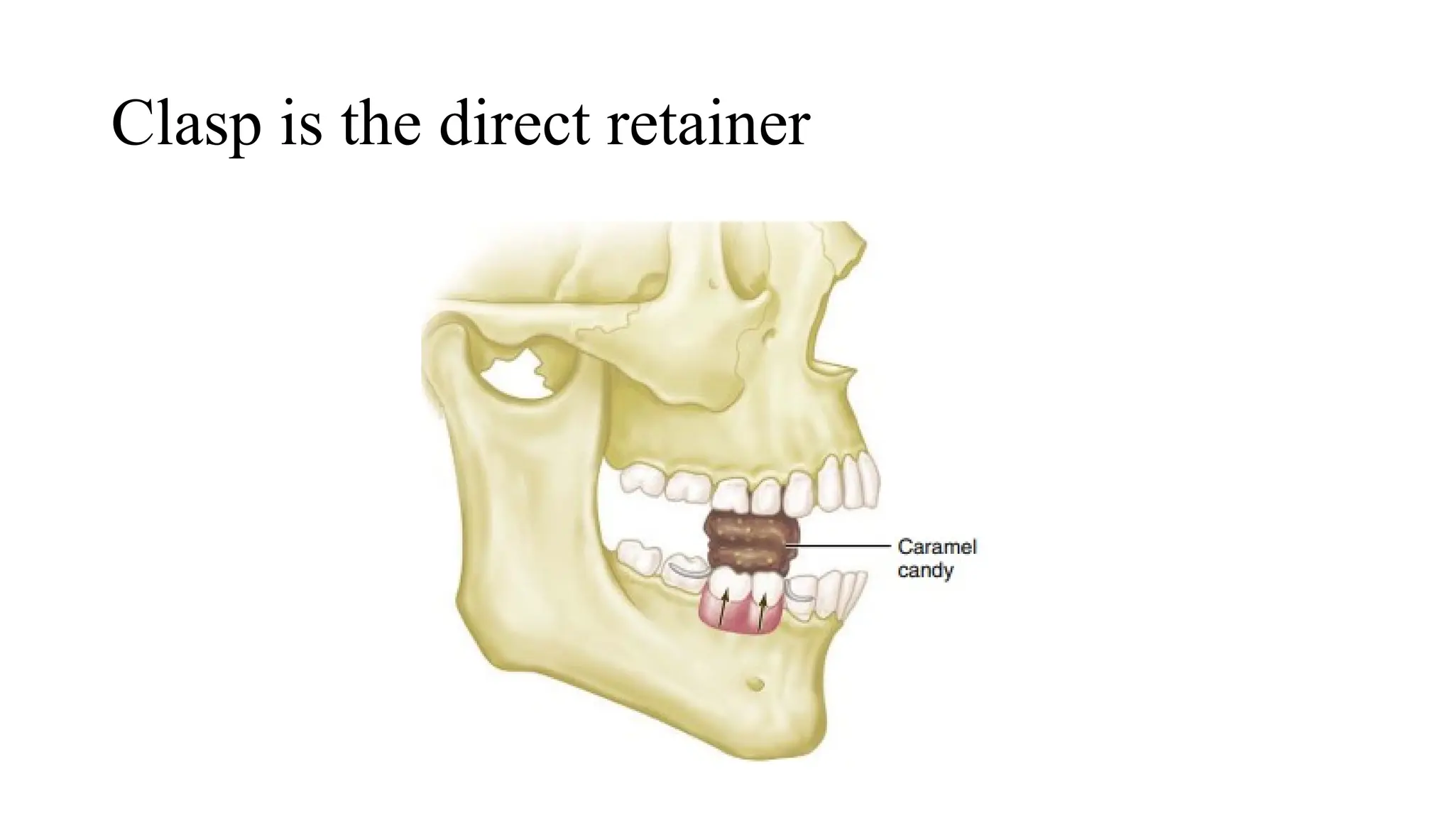 DIRECT RETAINERS IN REMOVABLE PARTIAL DENTURE | PPTX