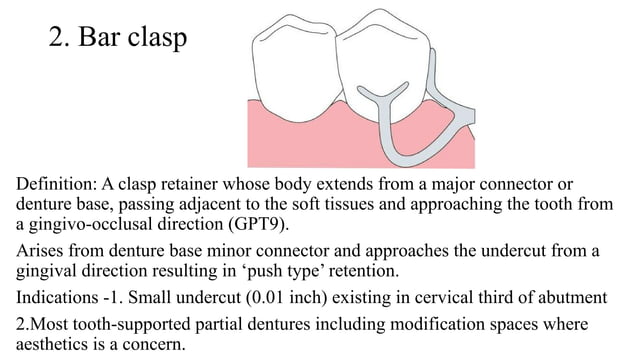 DIRECT RETAINERS IN REMOVABLE PARTIAL DENTURE | PPTX