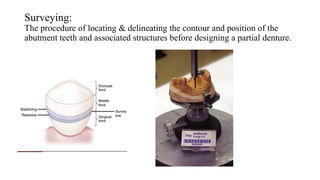 DIRECT RETAINERS IN REMOVABLE PARTIAL DENTURE | PPTX
