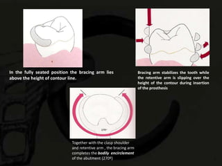 Direct Retainers in removable partial denture prosthodontics | PPTX