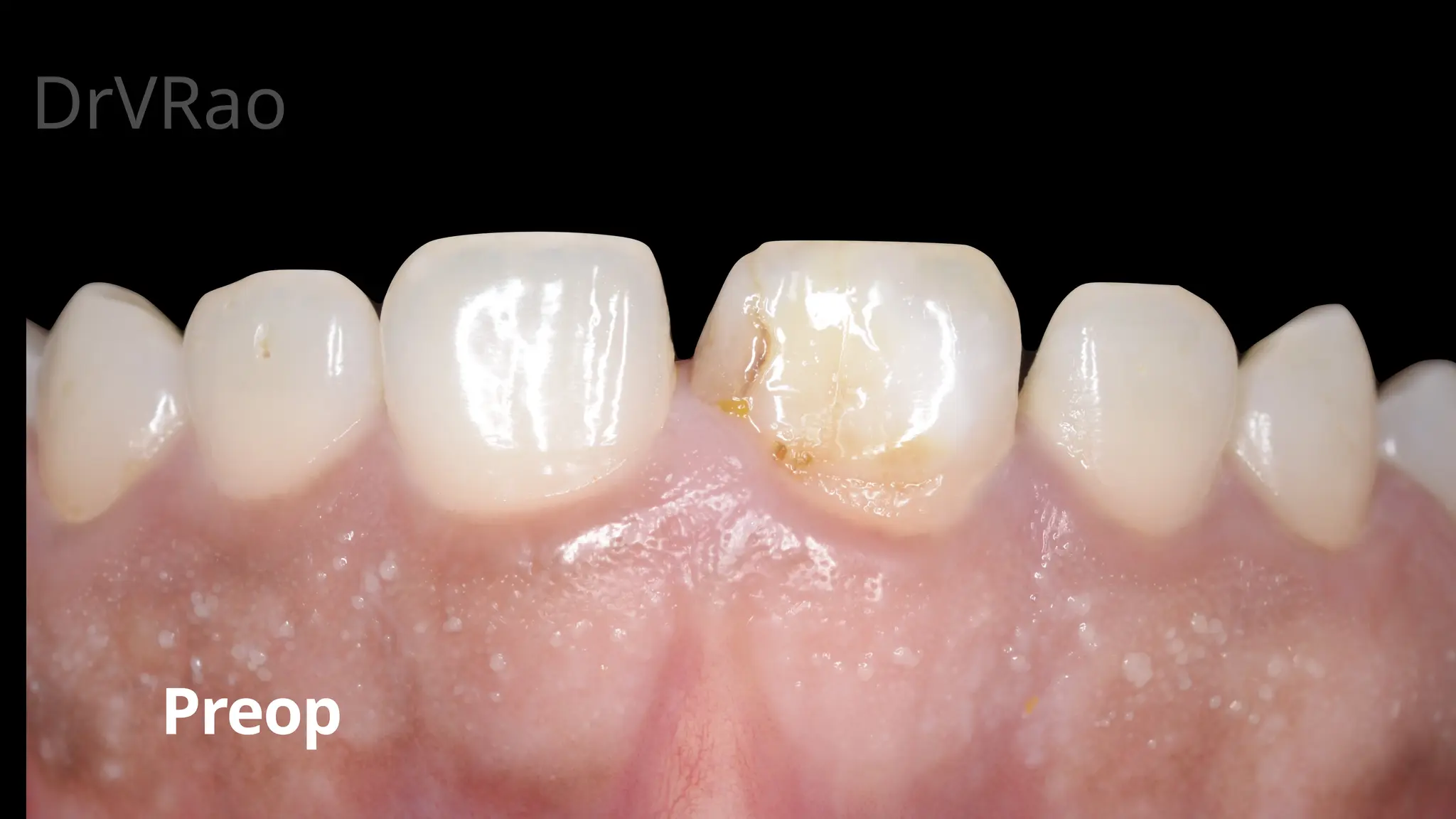 Direct Veneers done using the Bioclear technique | PPTX