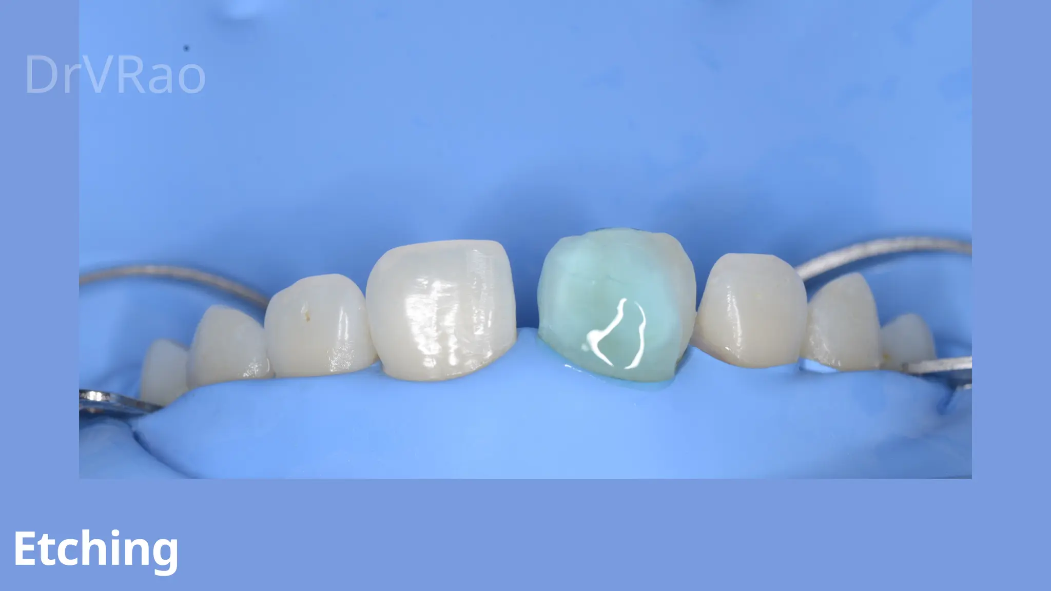 Direct Veneers done using the Bioclear technique | PPTX