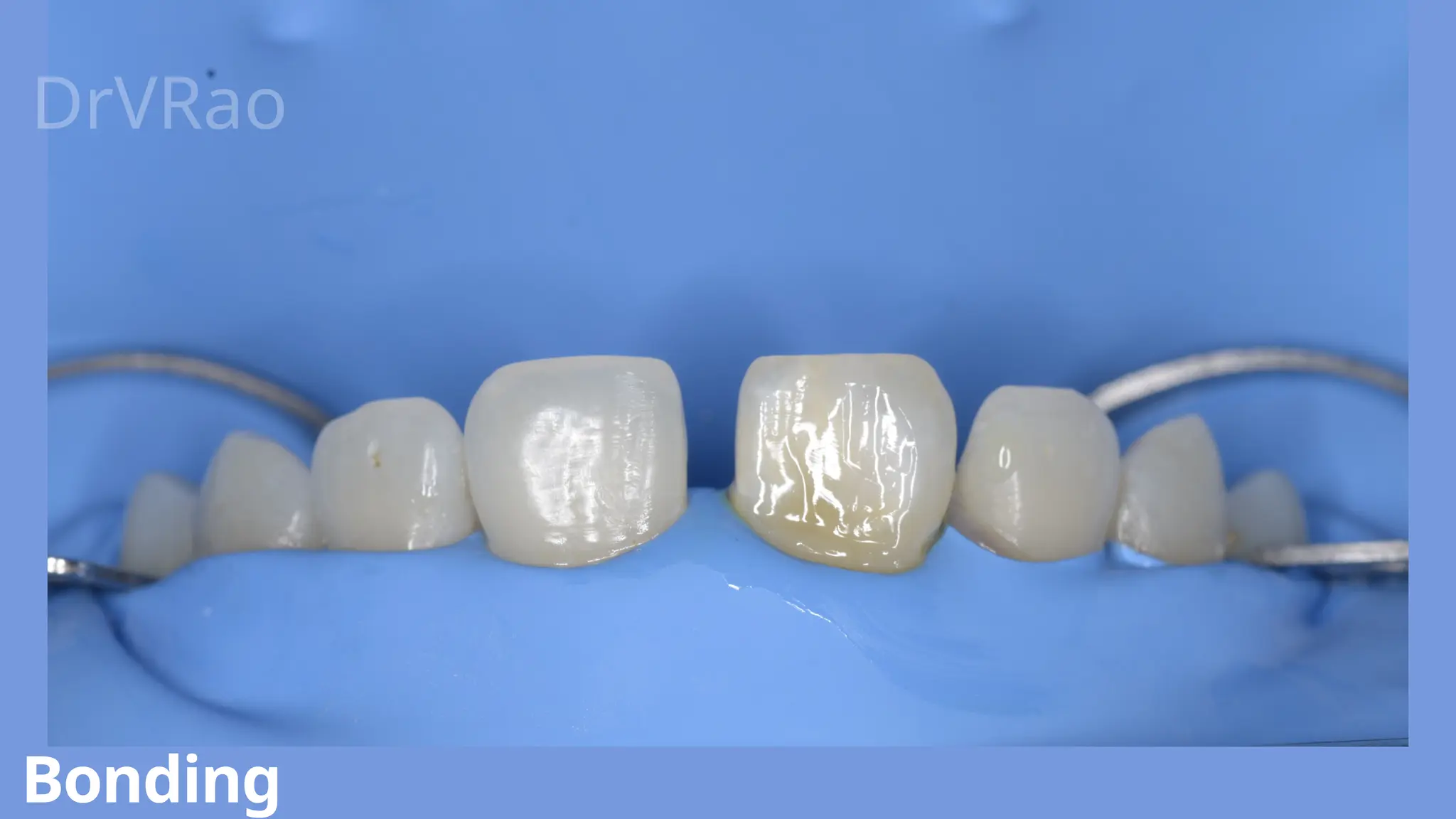 Direct Veneers done using the Bioclear technique | PPTX