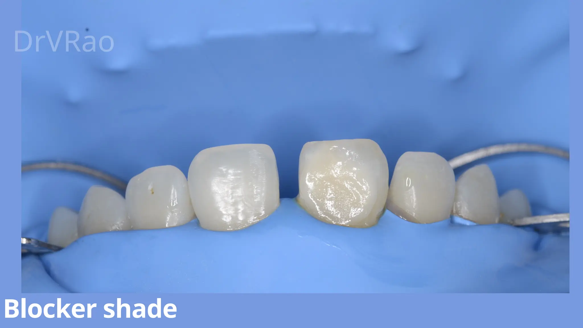 Direct Veneers done using the Bioclear technique | PPTX