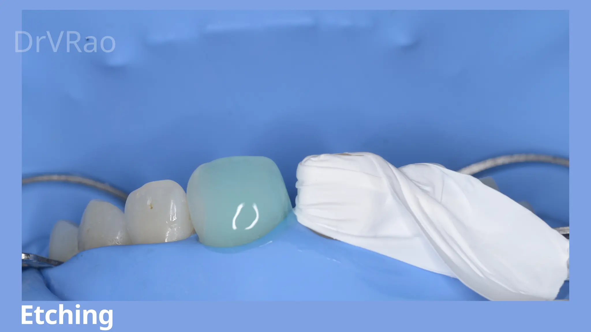 Direct Veneers done using the Bioclear technique | PPTX