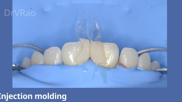 Direct Veneers done using the Bioclear technique | PPTX