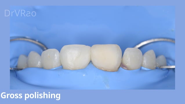 Direct Veneers done using the Bioclear technique | PPTX