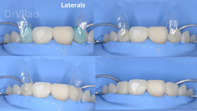 Direct Veneers done using the Bioclear technique | PPTX