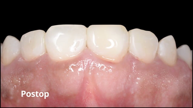Direct Veneers done using the Bioclear technique | PPTX